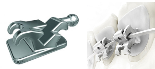 Ortodoncia con brackets linguales :: juliana morales odontologia